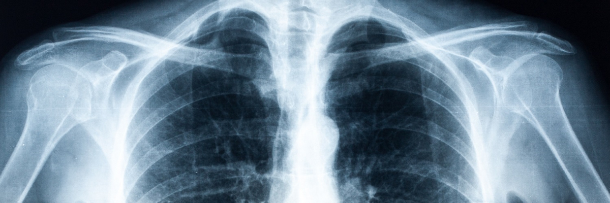 X-ray | Alfred Health